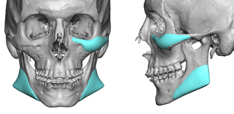 Custom Jaw Implants - Chin Implants | Eppley Custom Facial Implants