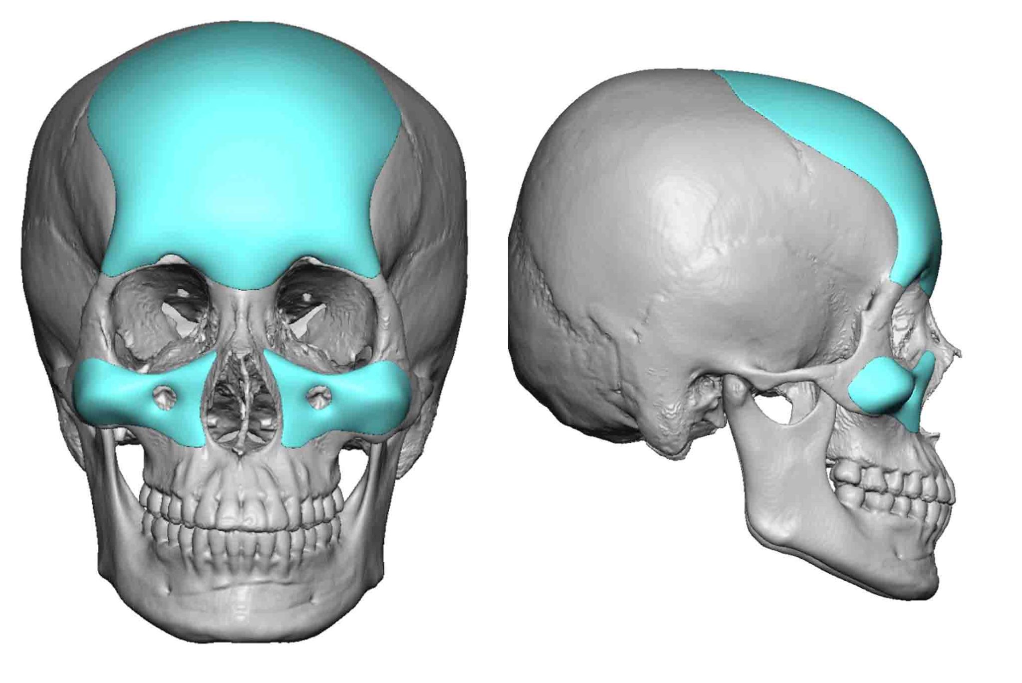 Custom Midface Implants - Cheek Implants | Eppley Custom Facial Implants