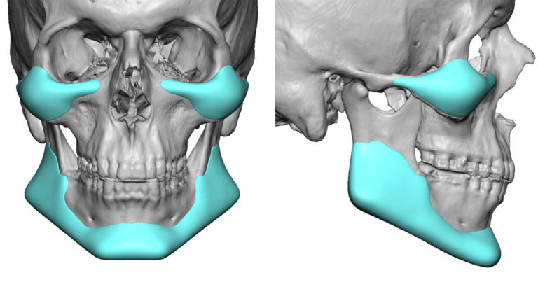 Total Face Implants | Eppley Custom Facial Implants