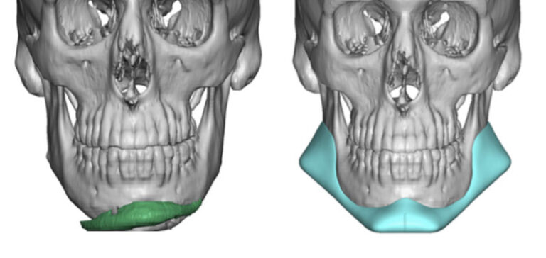 Custom Jaw Implants - Chin Implants | Eppley Custom Facial Implants