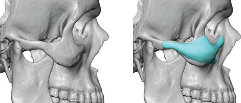 Custom Midface Implants - Cheek Implants | Eppley Custom Facial Implants