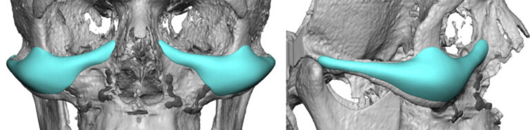 Custom Midface Implants - Cheek Implants | Eppley Custom Facial Implants