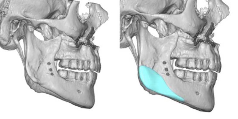 Custom Jaw Implants - Chin Implants | Eppley Custom Facial Implants