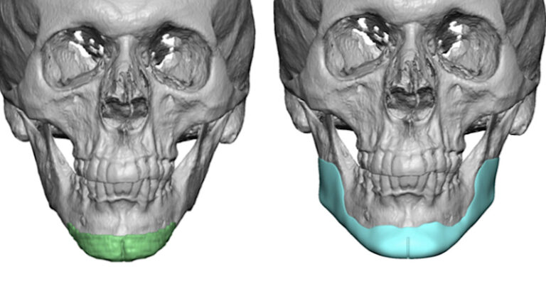Custom Jaw Implants - Chin Implants | Eppley Custom Facial Implants