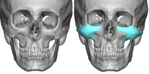Custom Midface Implants - Cheek Implants | Eppley Custom Facial Implants