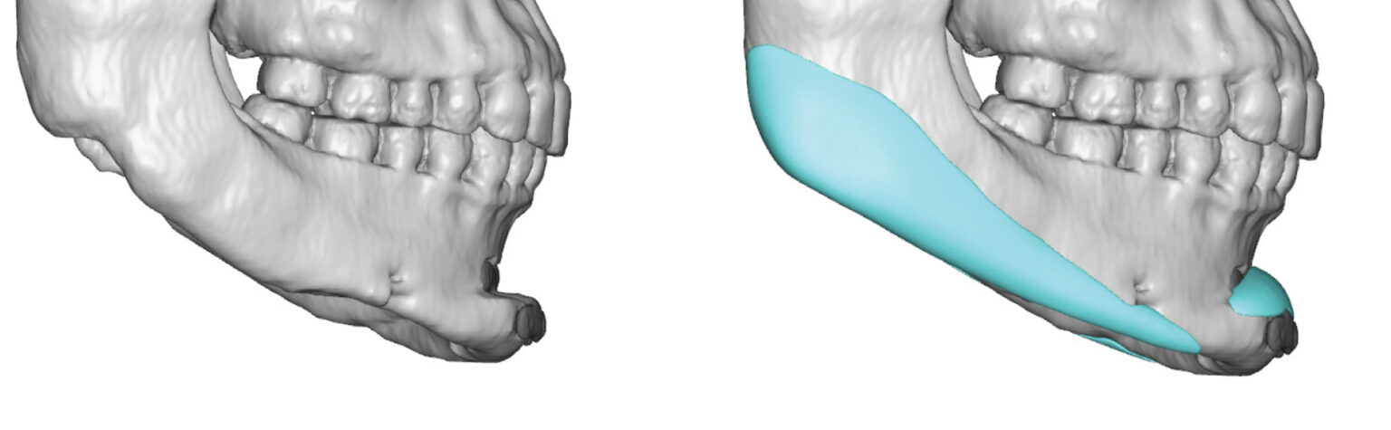 Custom Jaw Implants - Chin Implants | Eppley Custom Facial Implants