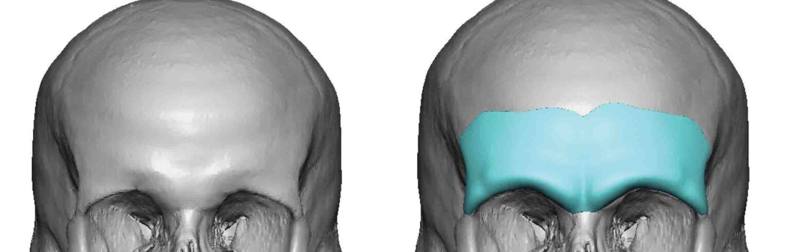 Custom Forehead Implants | Eppley Custom Facial Implants